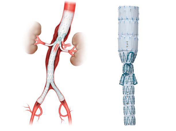 강남세브란스, 국내 첫 't-Branch 스텐트-그라프트 삽입 시술' 성공